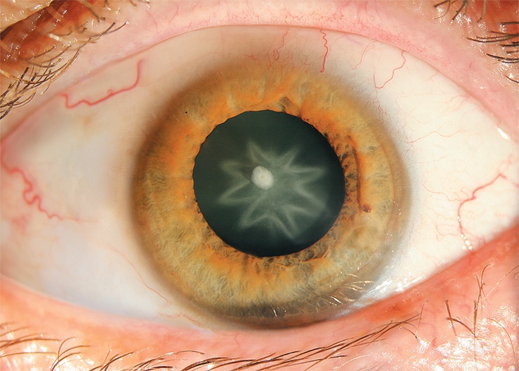 Penetrating Ocular Injury Management In Intraocular Foreign Body And Penetrating Ocular Injury Management In Intraocular Foreign Body And