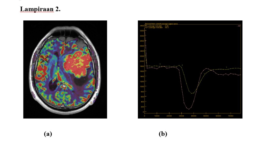 Ayo Deteksi Dini Penyakit Tumor Tanpa Radiasi dengan Pemeriksaan MRI ...